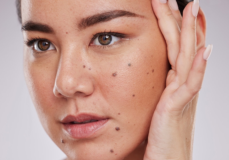 Skin Cancer Removal | Cahaba Dermatology & Skin Health Center
